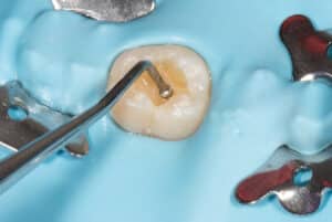 Single-Shade Composite Offers Excellent Esthetics - Decisions in Dentistry