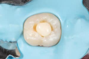 Single-Shade Composite Offers Excellent Esthetics - Decisions in Dentistry