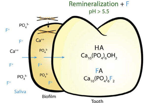 The Delicate Balance of Remineralization and Demineralization - Decisions in Dentistry