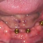 full-mouth-fig-13a - Decisions in Dentistry