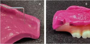 Clinical Considerations for Relining a Complete Denture - Decisions in ...