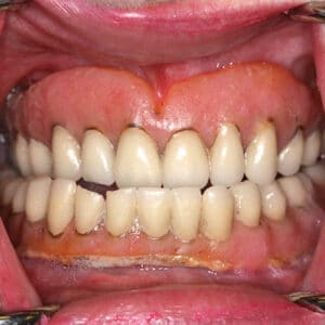 Clinical Considerations for Relining a Complete Denture - Decisions in ...