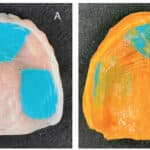 FIGURES 4A and 4B. Tissue stops (A) to reestablish vertical dimension ...