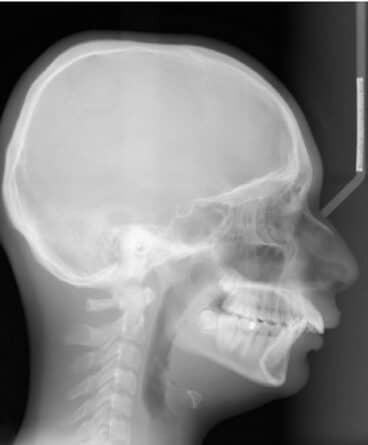 Understanding Orthognathic Surgery - Decisions in Dentistry