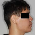 FIGURE 6. Posttreatment cephalometric radiograph illustrating ...