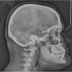 FIGURE 6. Posttreatment cephalometric radiograph illustrating ...