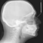 FIGURE 6. Posttreatment cephalometric radiograph illustrating ...