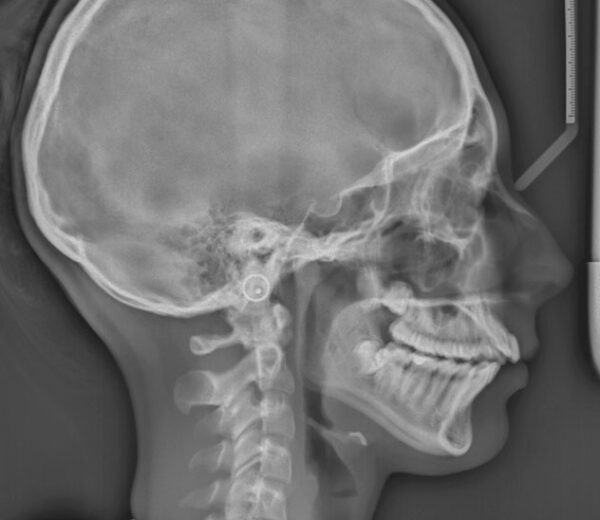 Understanding Orthognathic Surgery - Decisions in Dentistry