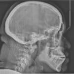 FIGURE 6. Posttreatment cephalometric radiograph illustrating ...