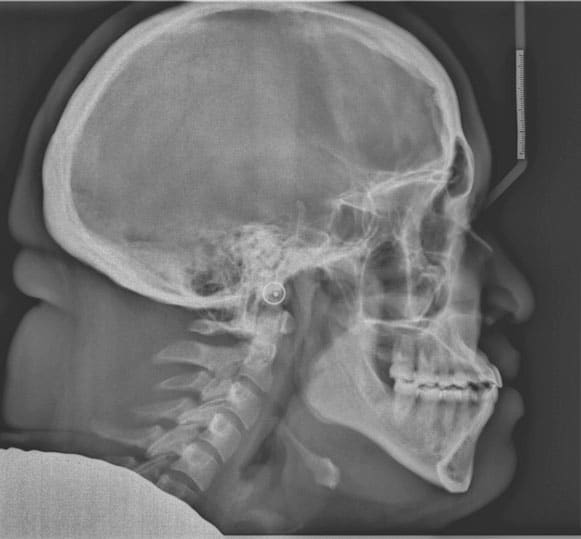 FIGURE 6 Posttreatment Cephalometric Radiograph Illustrating FIGURE 6 Posttreatment Cephalometric Radiograph Illustrating
