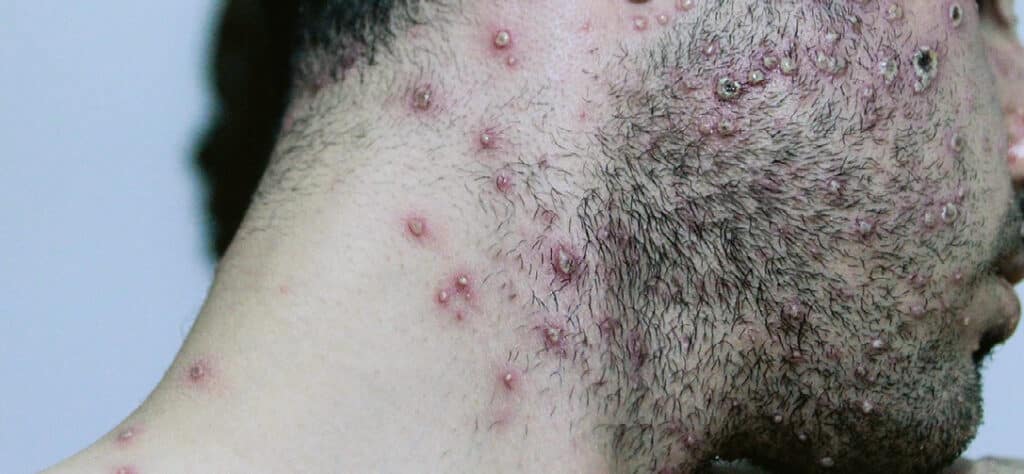 Presentation of Monkeypox in the Dental Setting - Decisions in Dentistry