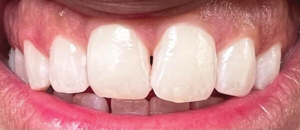 Conventional and Alternative Approaches to Enamel Remineralization ...