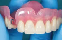 Common Ulcerations of the Oral Cavity - Decisions in Dentistry