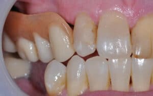 Semi-Precision Root Anchors For Partial Dentures - Decisions in Dentistry