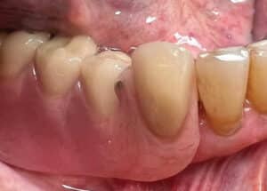 Semi-Precision Root Anchors For Partial Dentures - Decisions in Dentistry