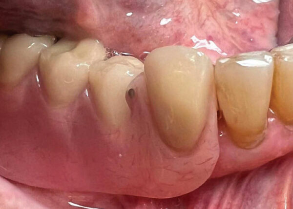 Semi-Precision Root Anchors For Partial Dentures - Decisions in Dentistry