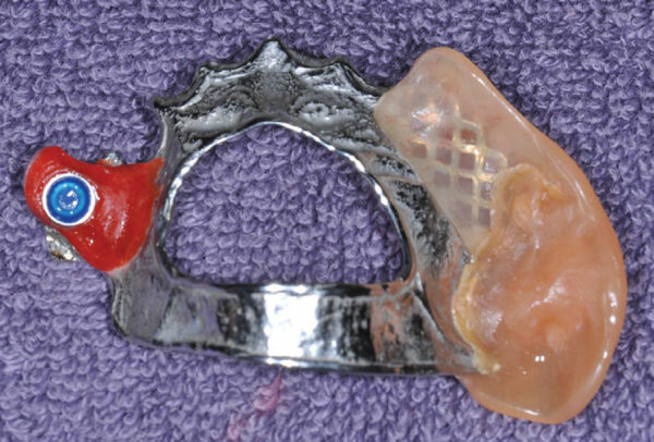 Semi-Precision Root Anchors For Partial Dentures - Decisions in Dentistry