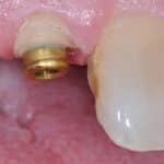 root-anchors - Decisions in Dentistry