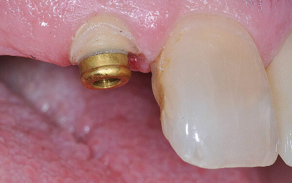 Semi-Precision Root Anchors For Partial Dentures - Decisions in Dentistry
