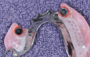 Semi-Precision Root Anchors For Partial Dentures - Decisions in Dentistry
