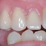 root-anchors - Decisions in Dentistry