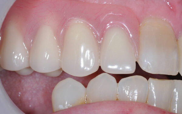 Semi-Precision Root Anchors For Partial Dentures - Decisions in Dentistry
