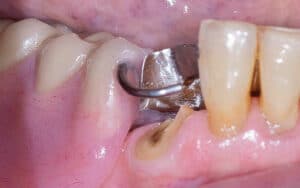Semi-Precision Root Anchors For Partial Dentures - Decisions in Dentistry