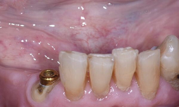 Semi-Precision Root Anchors For Partial Dentures - Decisions in Dentistry