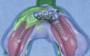 Semi-Precision Root Anchors For Partial Dentures - Decisions in Dentistry