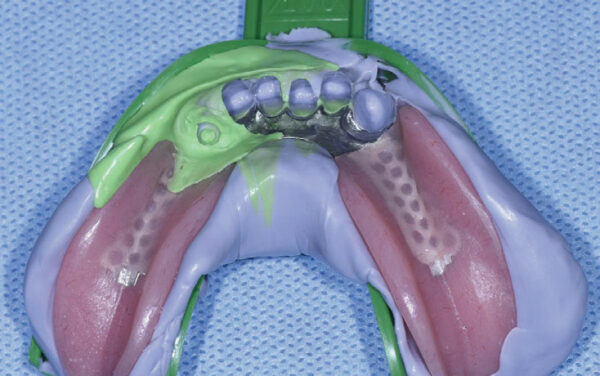 Semi-Precision Root Anchors For Partial Dentures - Decisions in Dentistry
