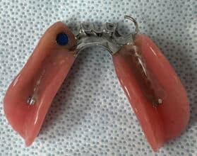 Semi-Precision Root Anchors For Partial Dentures - Decisions in Dentistry