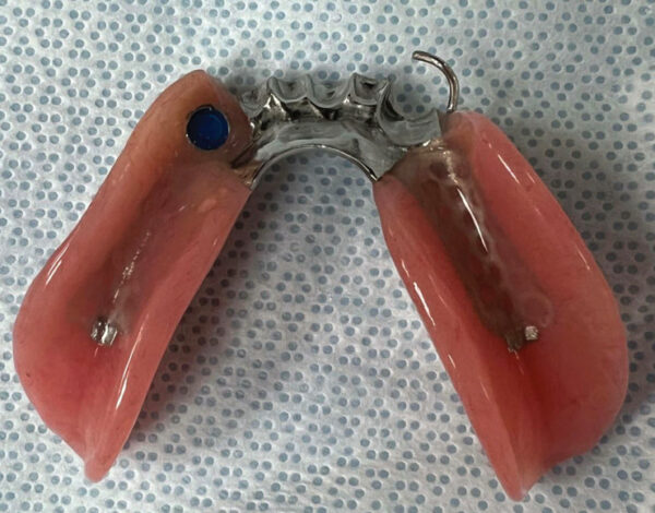 Semi-Precision Root Anchors For Partial Dentures - Decisions in Dentistry