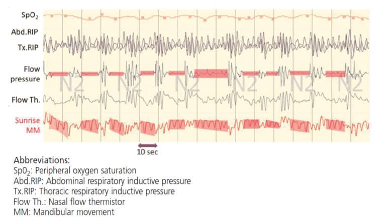 Mandibular Movement Monitoring for Sleep-Related Breathing Disorders ...