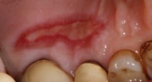 Soft Tissue Graft Alternatives for Treating Mucogingival Defects ...