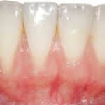 FIGURE 2D. Three-month postoperative view after tunneling with ...