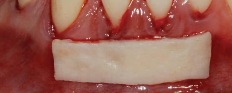 Soft Tissue Graft Alternatives for Treating Mucogingival Defects ...