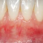 FIGURE 2B. Localized view of tunneled recipient site prior to insertion ...