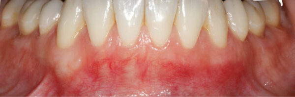 Soft Tissue Graft Alternatives for Treating Mucogingival Defects ...