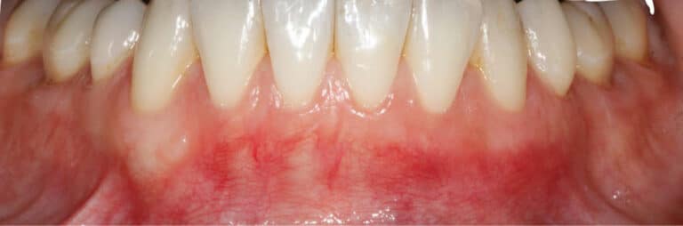 Soft Tissue Graft Alternatives for Treating Mucogingival Defects ...