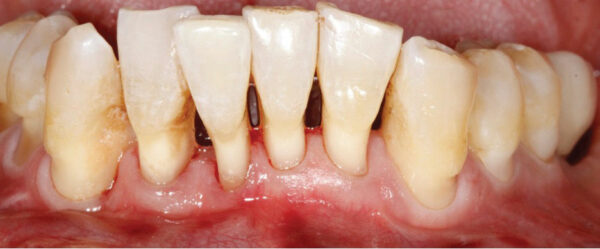 Soft Tissue Graft Alternatives for Treating Mucogingival Defects ...
