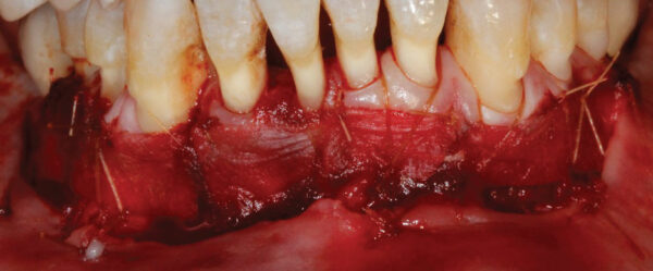 Soft Tissue Graft Alternatives for Treating Mucogingival Defects ...