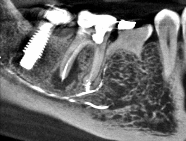 Overview and Management Of Endodontic Iatrogenic Extrusions - Decisions ...