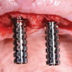 FIGURE 11. Prefabricated jig attached to temporary abutments prior to ...