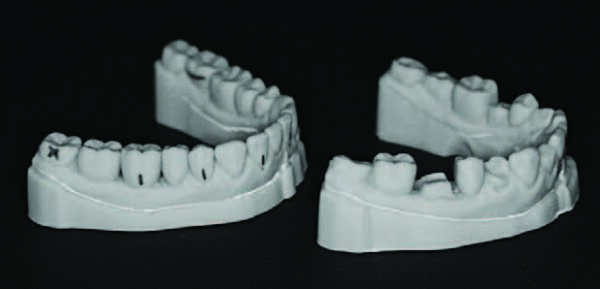 Occlusal Plane Correction Using Flowable Composite In a Maxillary ...