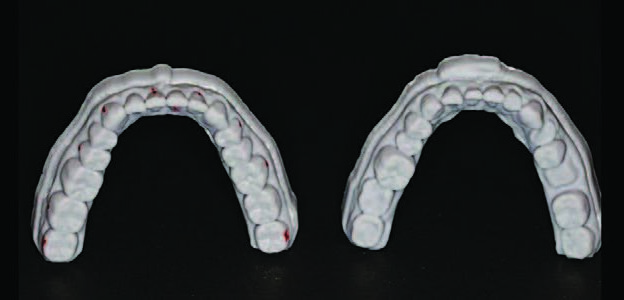 Occlusal Plane Correction Using Flowable Composite In a Maxillary ...