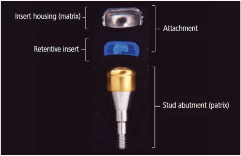 Attachment Selection for Implant-Supported Overdentures - Decisions in ...