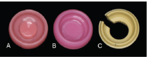 Attachment Selection for Implant-Supported Overdentures - Decisions in ...