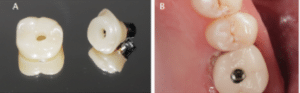 Screwmentable Implant Crowns - Decisions in Dentistry