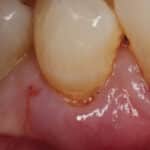 external-root-750x430 - Decisions in Dentistry
