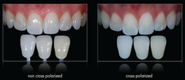 Utility of Cross-Polarized Photography in Dental Shade Matching ...